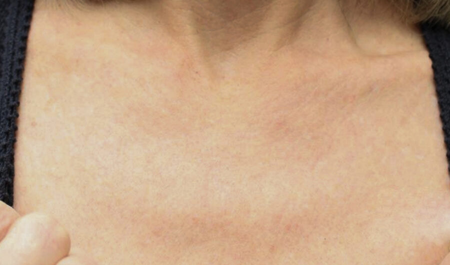 BBL® Photofacials Near Minneapolis | Metropolitan Skin Clinic