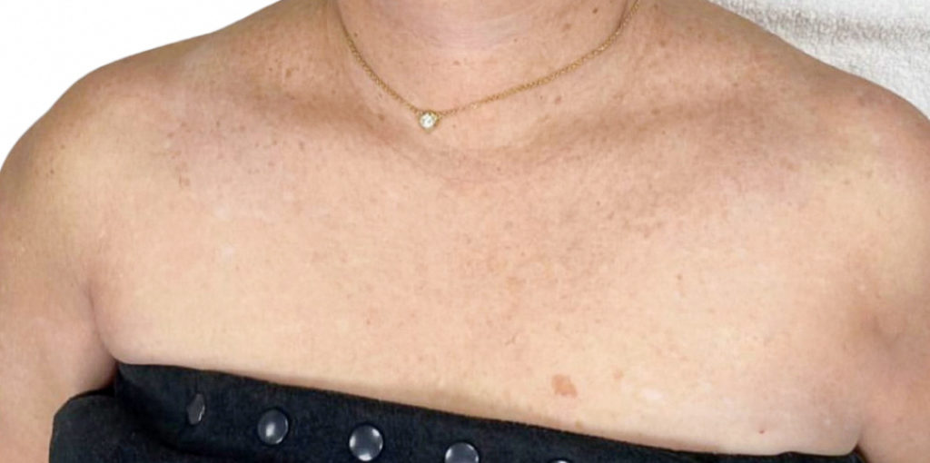 BBL Laser Treatment in Edina, MN | Metropolitan Skin Clinic