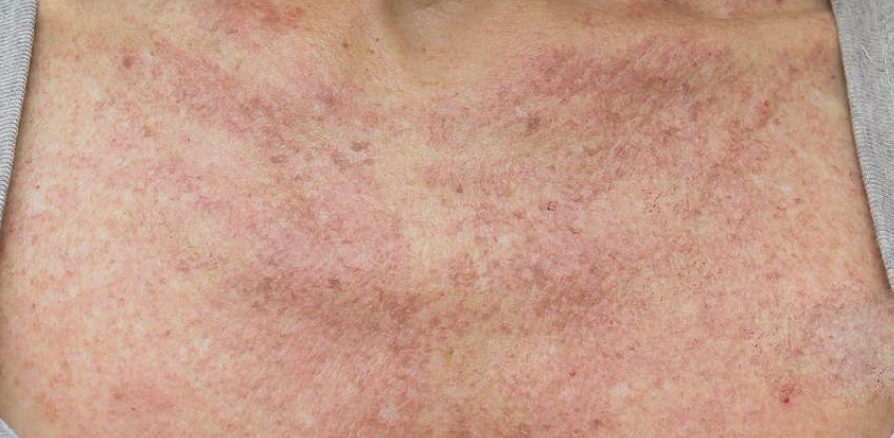 BBL® Photofacials Near Minneapolis | Metropolitan Skin Clinic