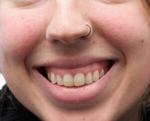 Drooping Mouth Corners | Metropolitan Skin Clinic