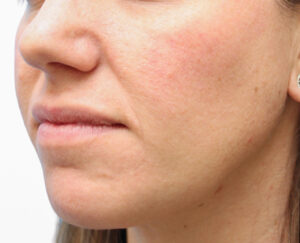 Drooping Mouth Corners | Metropolitan Skin Clinic