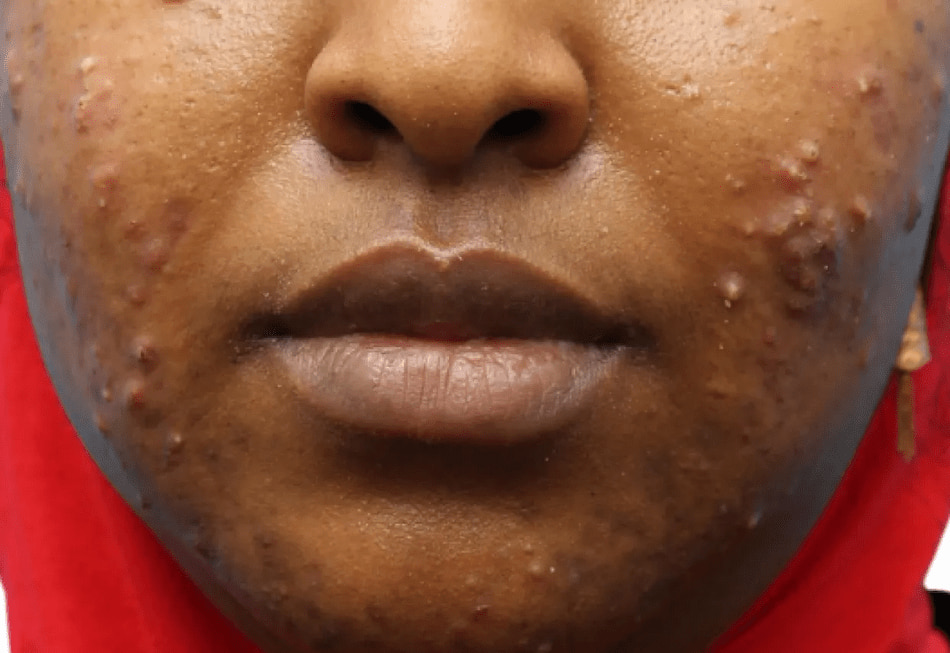 Acne Treatments in Minneapolis, MN | Metropolitan Skin Clinic