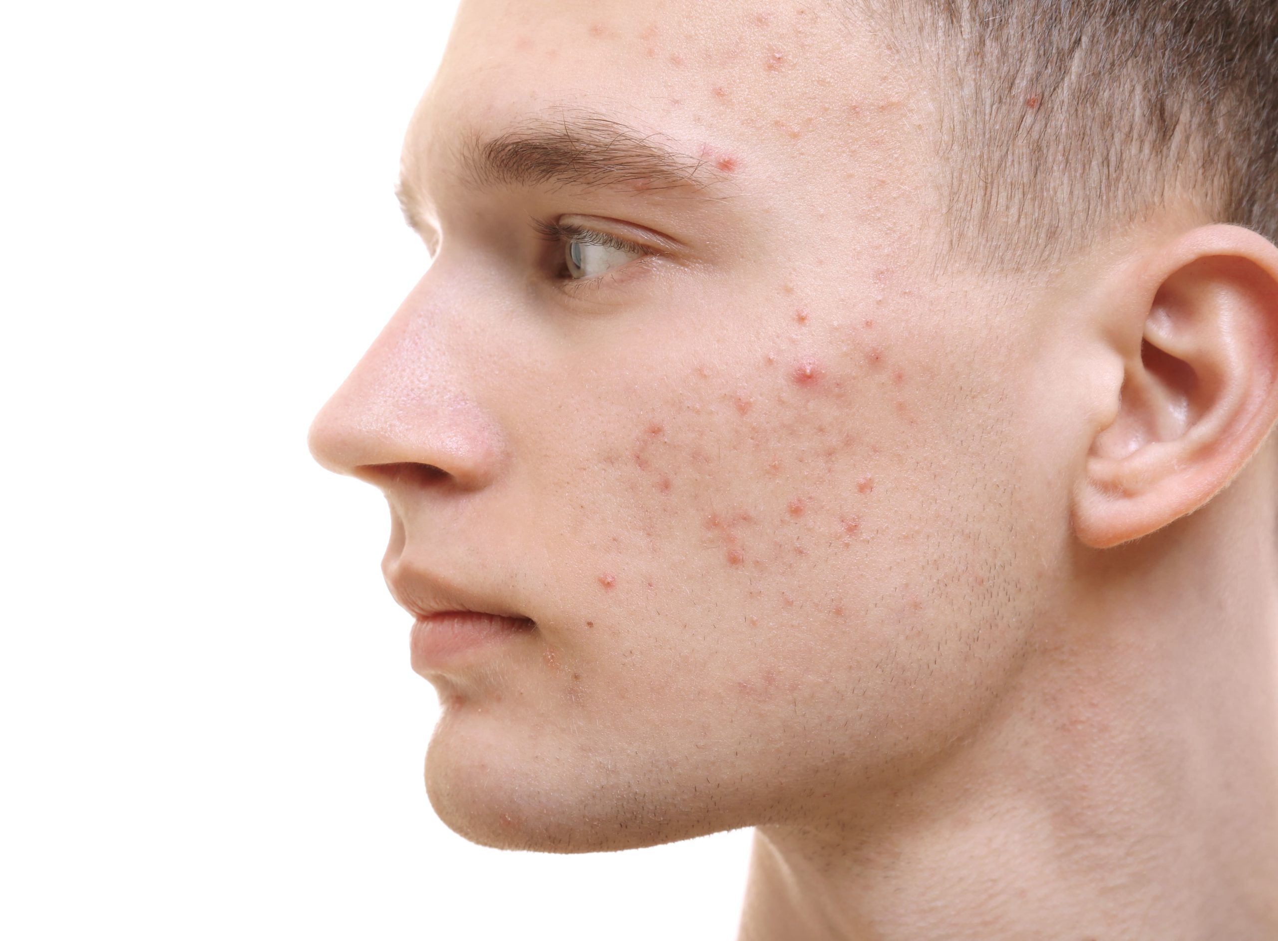 Acne Treatments in Minneapolis, MN | Metropolitan Skin Clinic