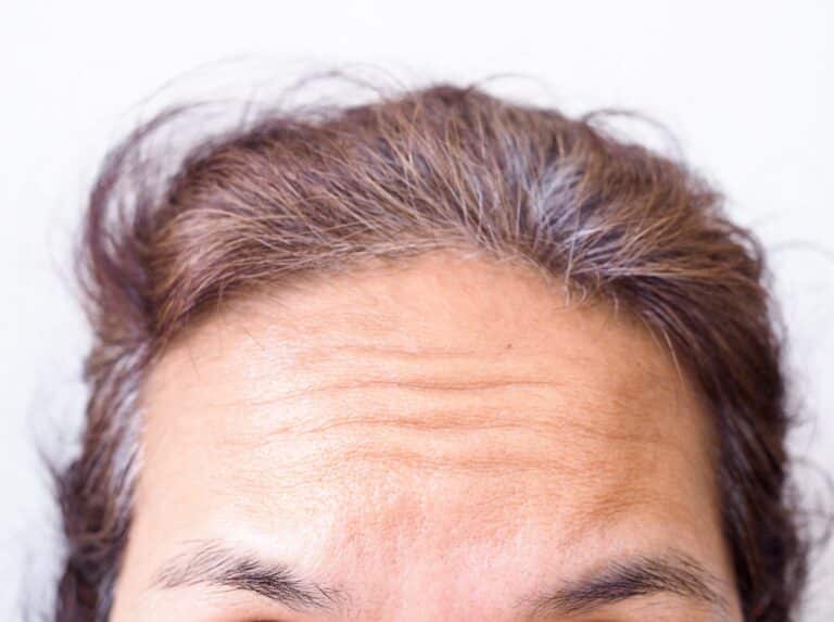 Horizontal Forehead Lines Treatment | St. Paul, Minneapolis ...