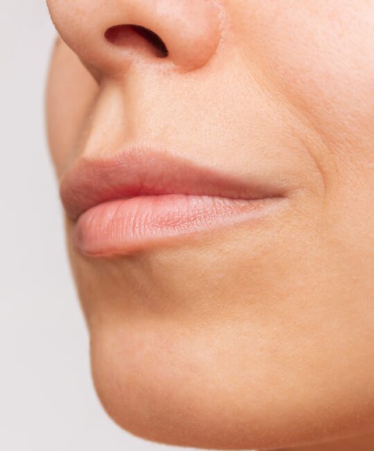 Upper Thin Lips Treatment in Minneapolis | Metropolitan Skin Clinic