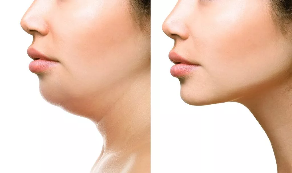 Everything You Need to Know About the Kybella Procedure - Metropolitan ...