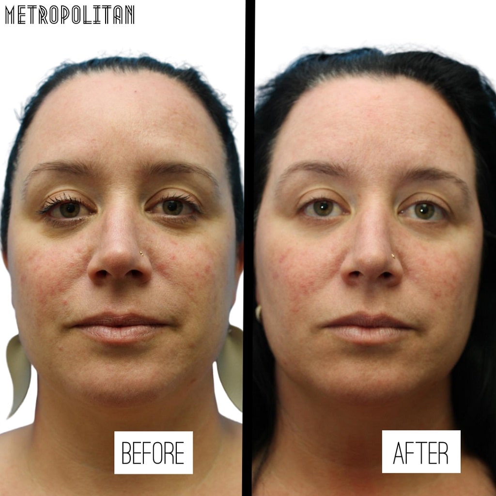 Halo vs BBL Laser Treatment: What Is the Difference?